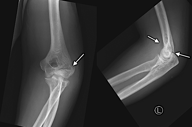 CAPITELLAR FRACTURE ADULT | Hand Surgery Resource
